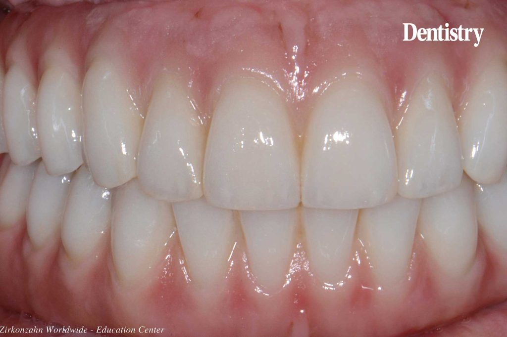 Bar-supported bridges with Prettau 2 Dispersive - Dentistry
