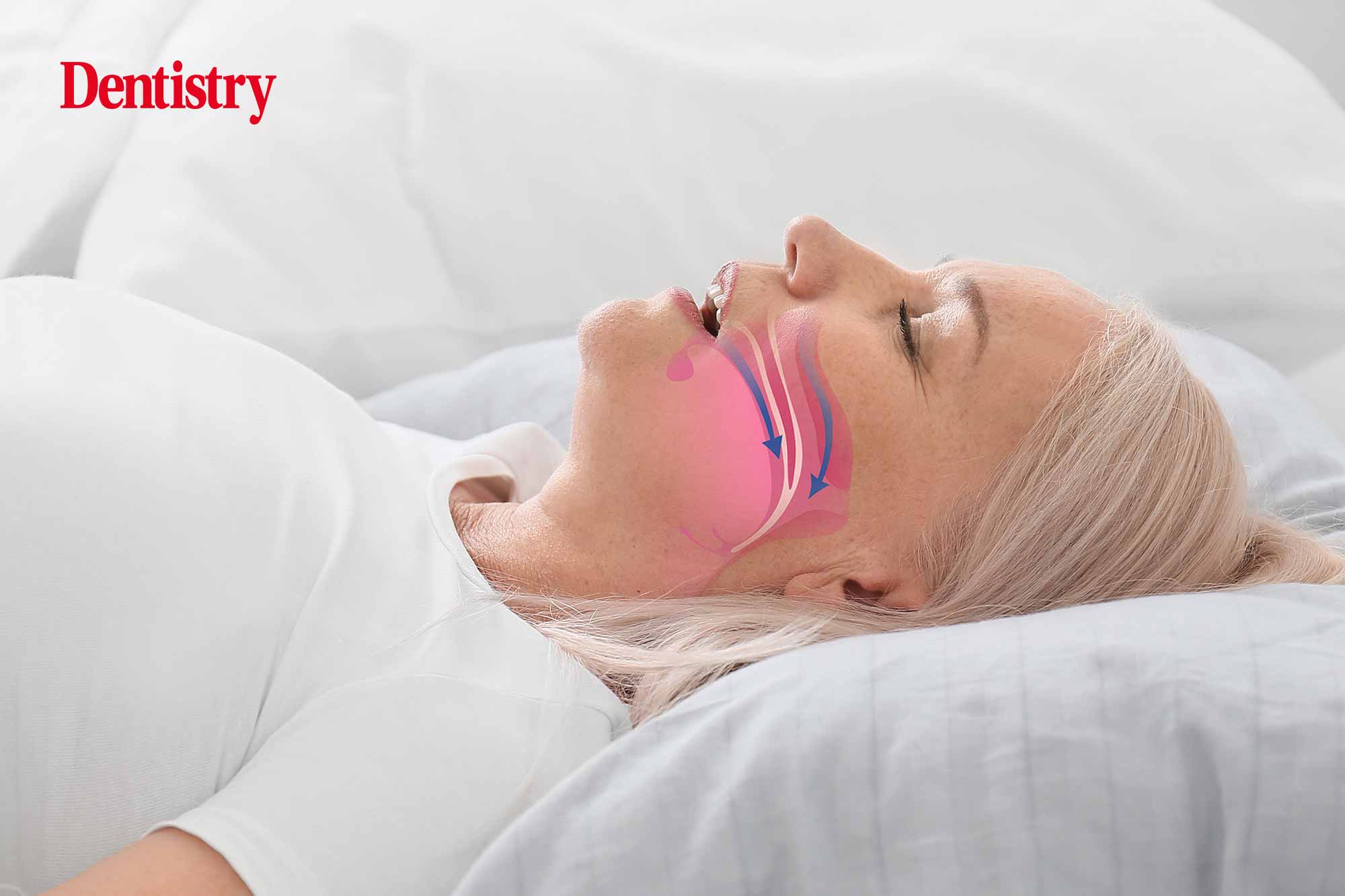 Snoring, facial growth and nutrition What are the links? - Dentistry