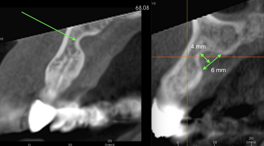 Using CBCT images to detect Stafne bone cavities - Dentistry