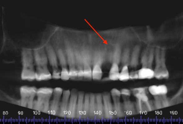 Using CBCT images to detect Stafne bone cavities - Dentistry
