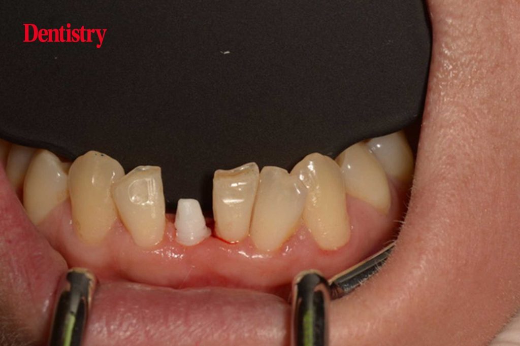 Bredent’s Whitesky implants with Dr Holger Scholz - Dentistry.co.uk