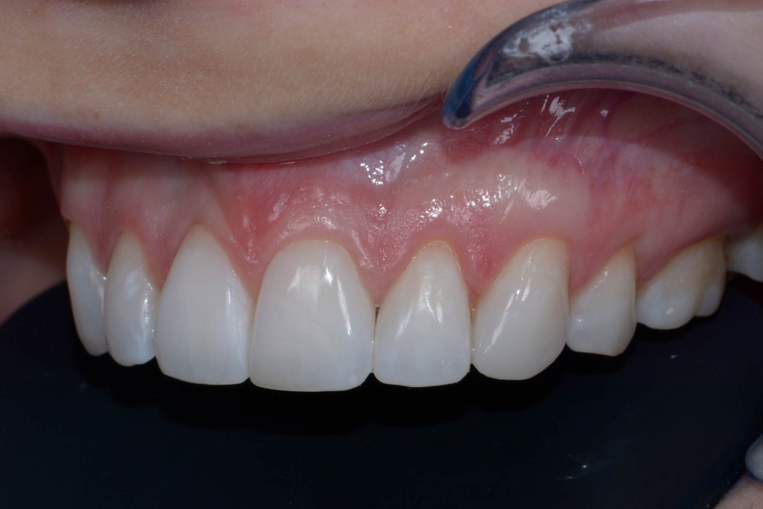 Composite restorations: closing and open gingival embrasure - Dentistry