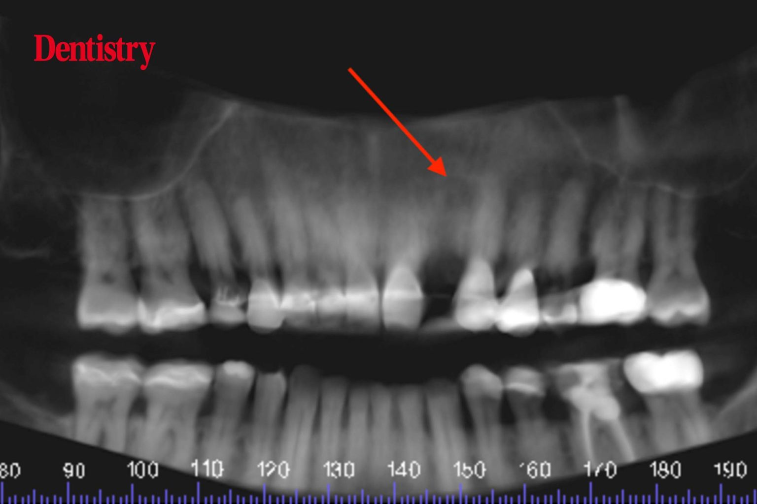 Case of the week – Stafne bone cavities - Dentistry