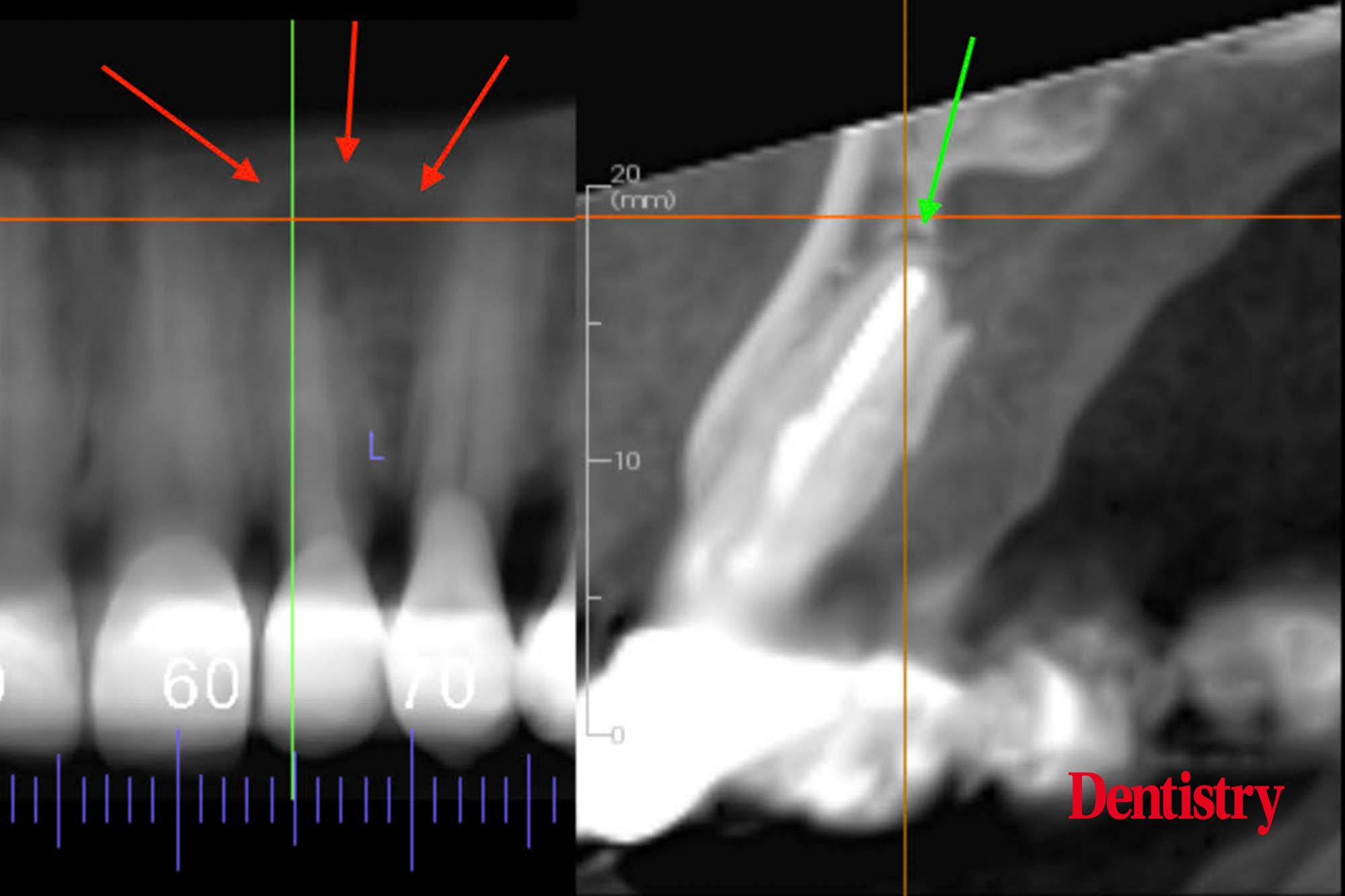 Case of the week – Stafne bone cavities - Dentistry