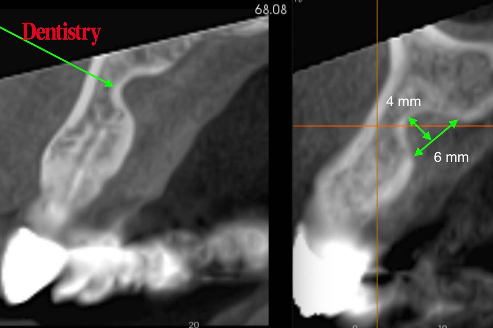 Case of the week – Stafne bone cavities - Dentistry