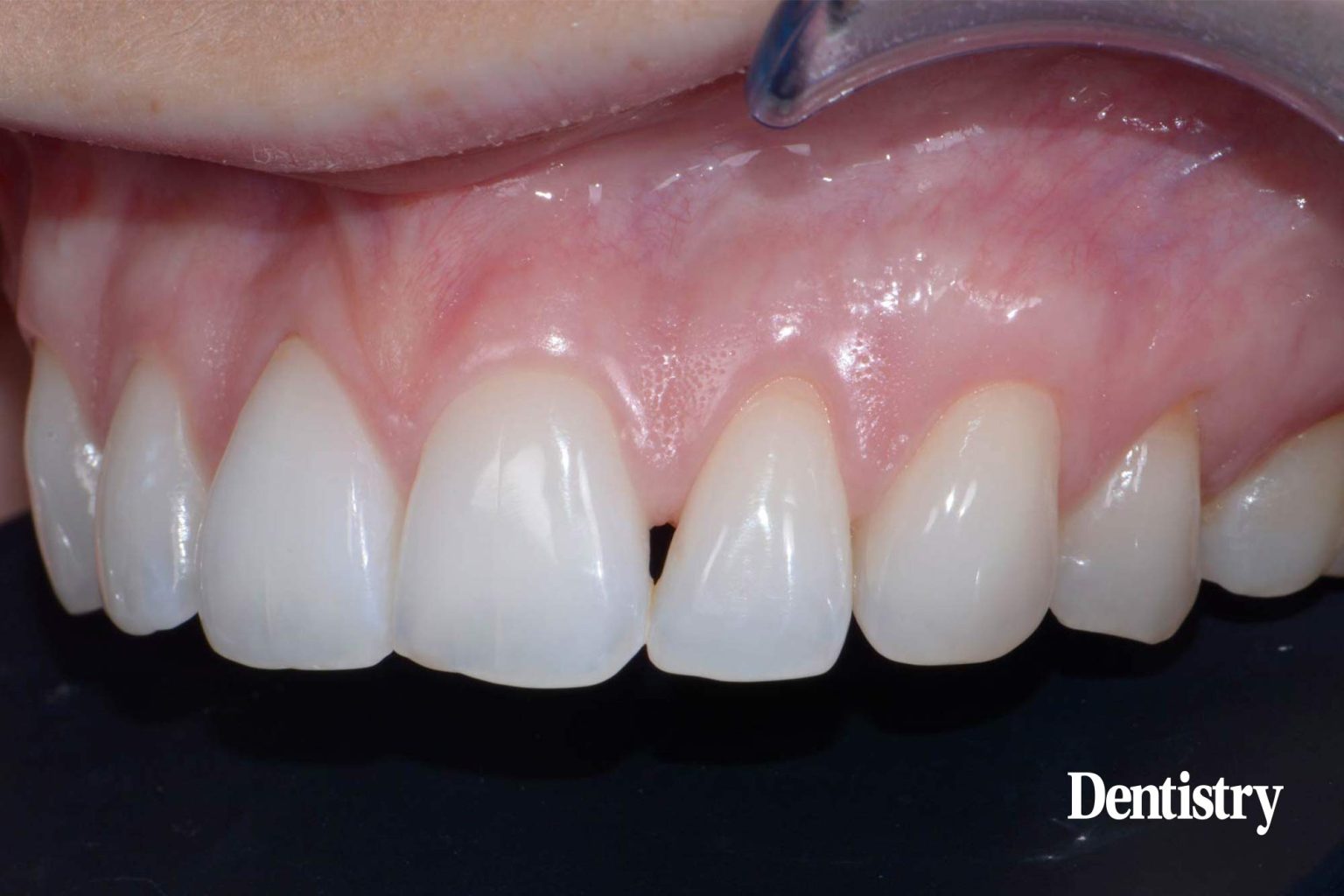Composite restorations: closing and open gingival embrasure - Dentistry