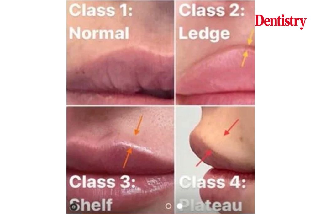 Facial Aesthetics 101 – the growing trend of dissolving filler - Dentistry