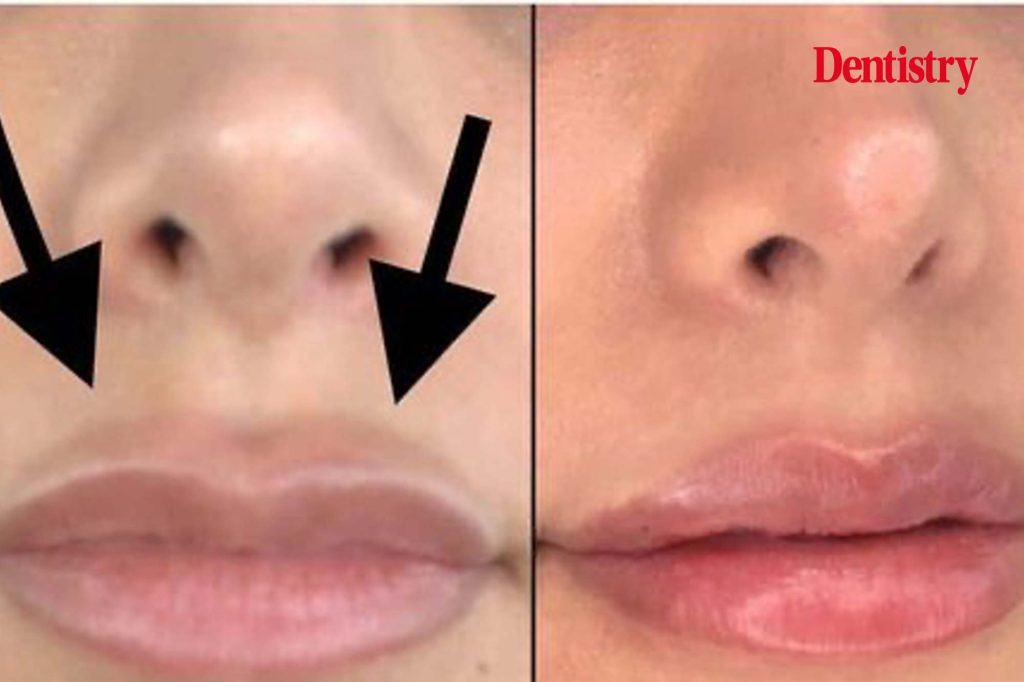 Facial Aesthetics 101 – the growing trend of dissolving filler - Dentistry