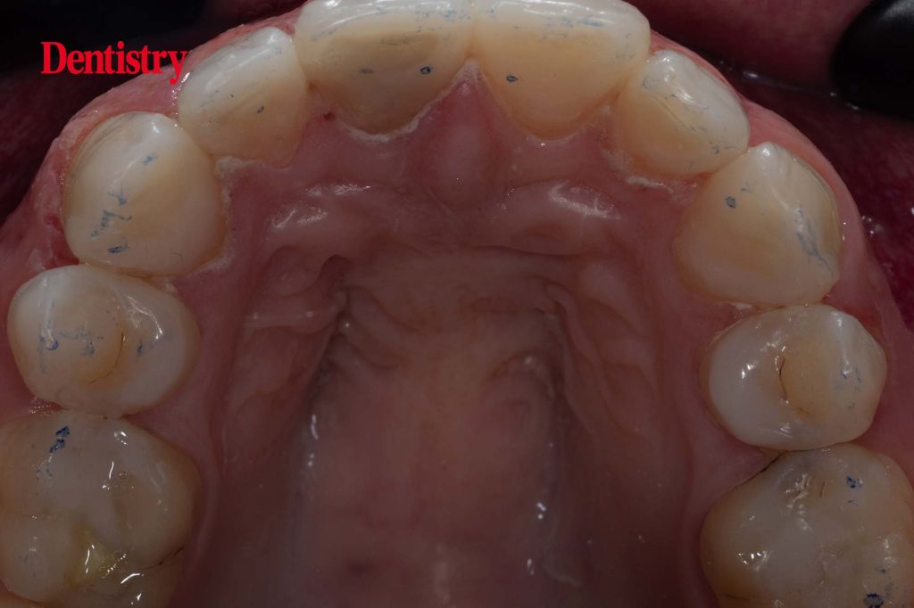 Prosthodontips – occlusion revisited: part two - Dentistry