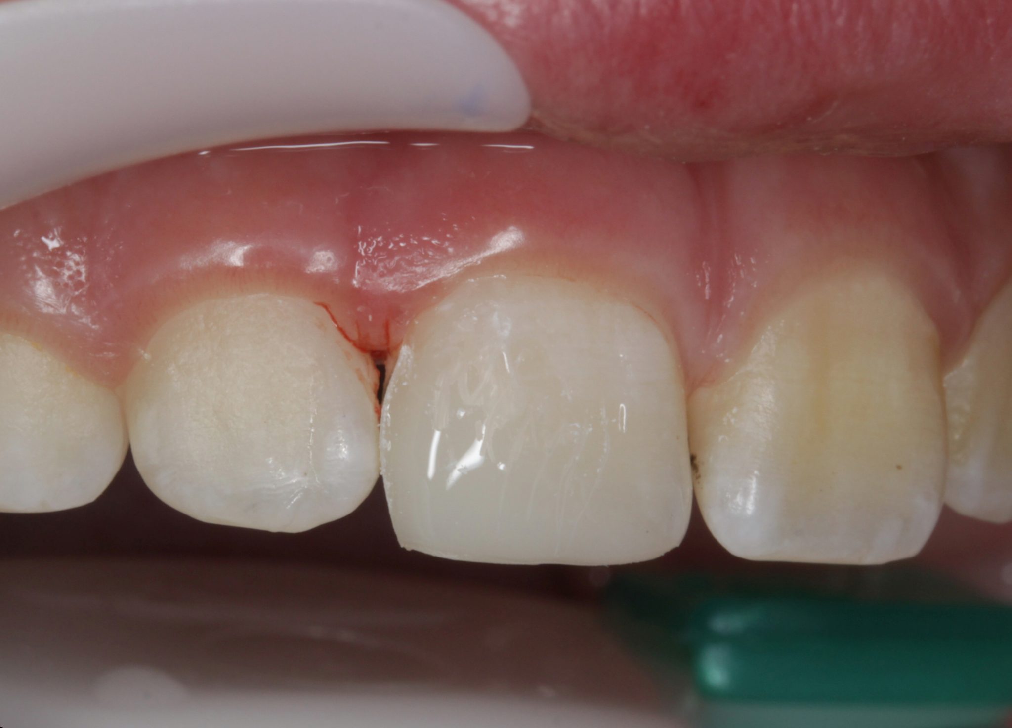 Natural incisal edge reconstruction - Dentistry
