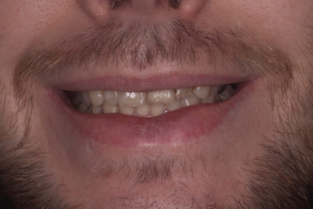 Prosthodontips – toothwear and injection moulding - Dentistry