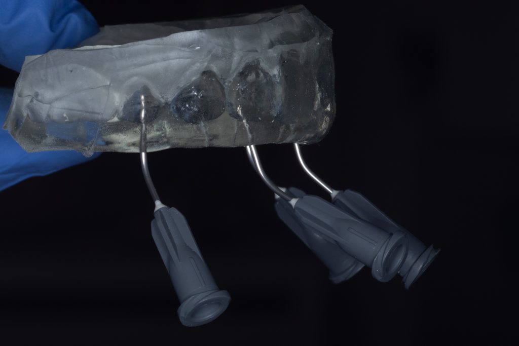 Prosthodontips – toothwear and injection moulding - Dentistry