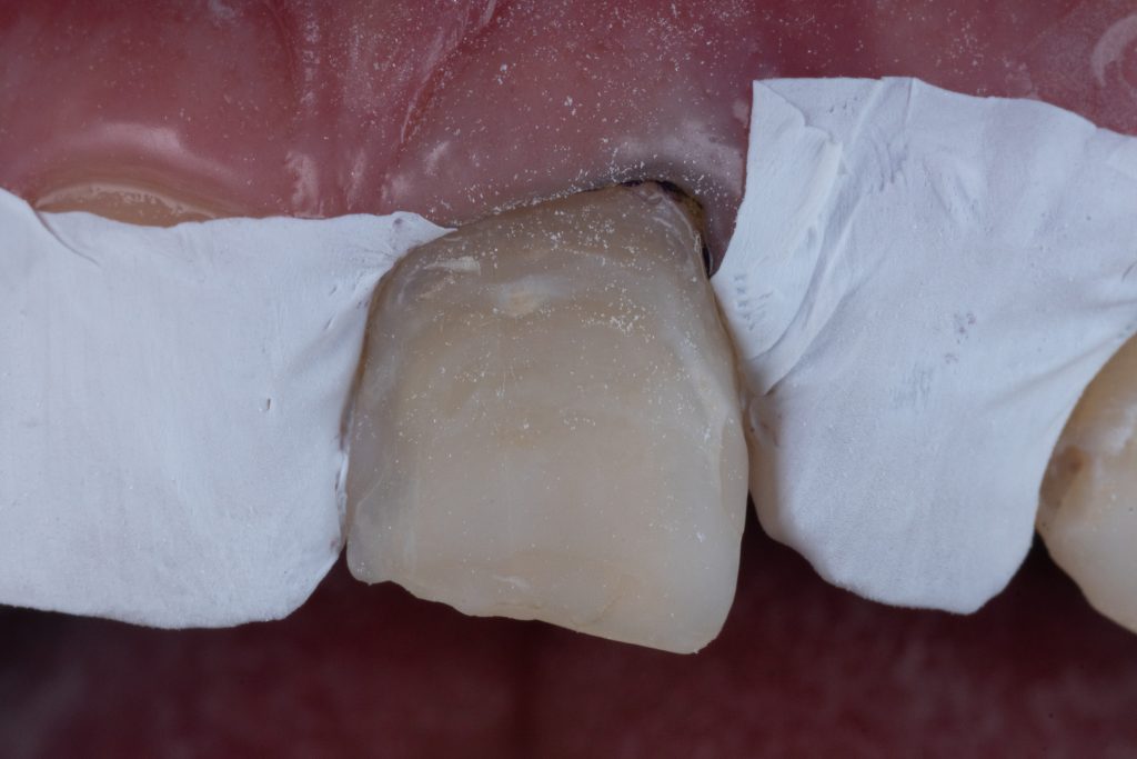 Prosthodontips – toothwear and injection moulding - Dentistry