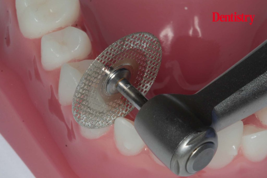 Total Orthodontics – IPR is nothing to fear - Dentistry