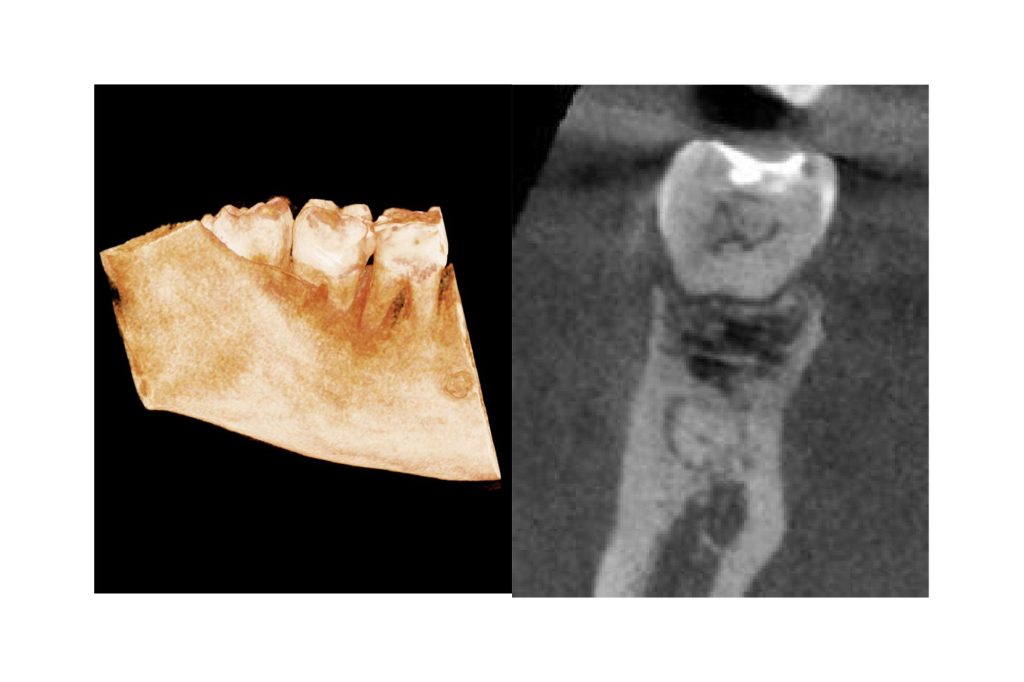 Case of the week – spotting potentially serious lesions in LR7 - Dentistry