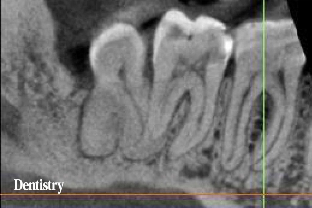 Case of the week – spotting potentially serious lesions in LR7 - Dentistry