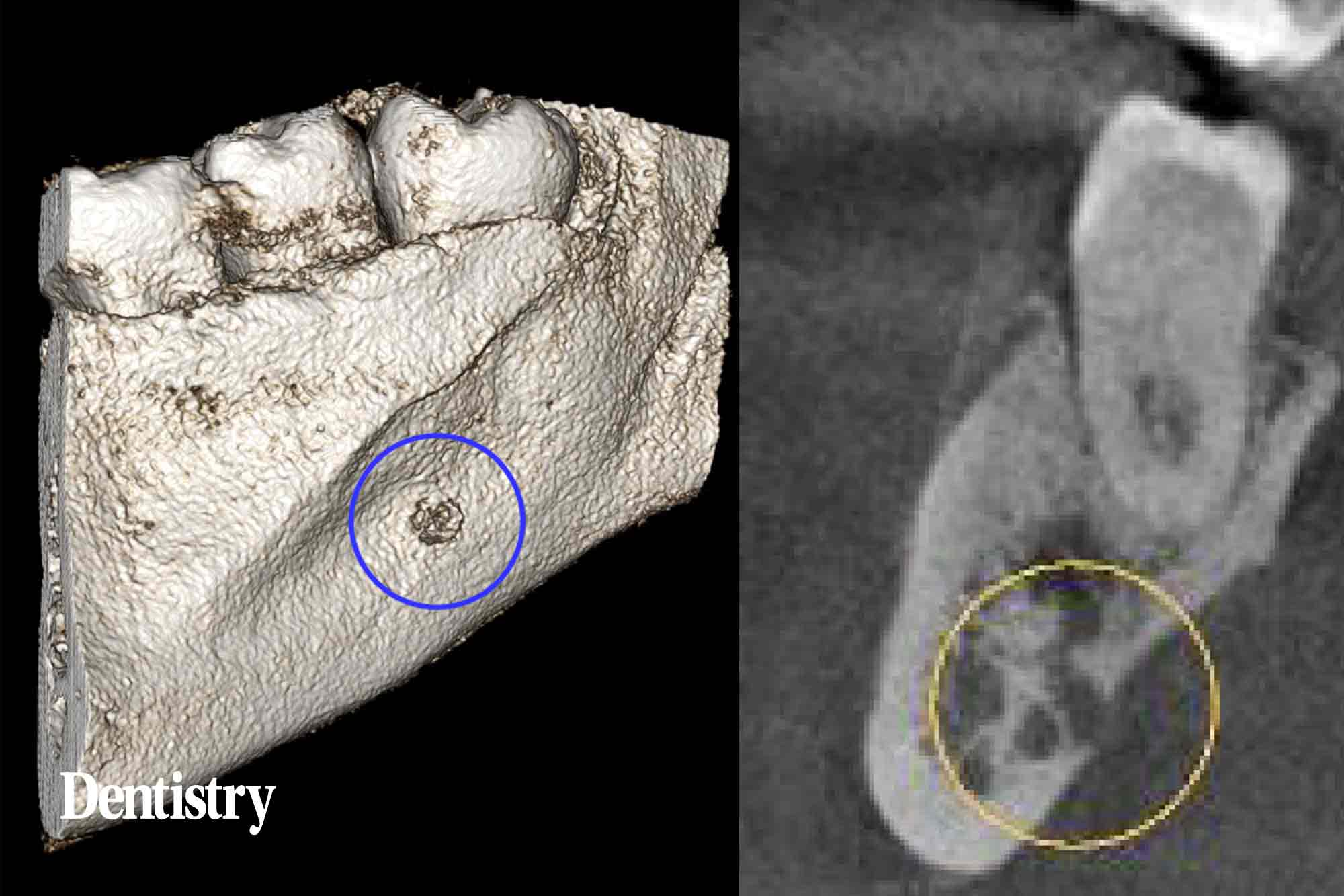 Case of the week – spotting potentially serious lesions in LR7 - Dentistry