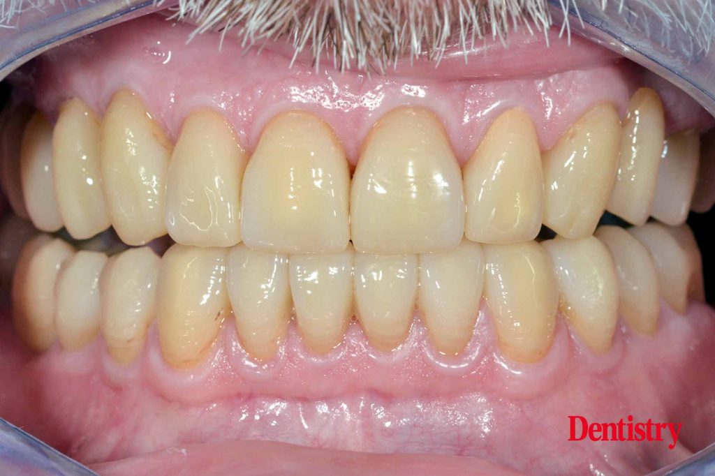 Cementation of crowns without chipping – part two - Dentistry