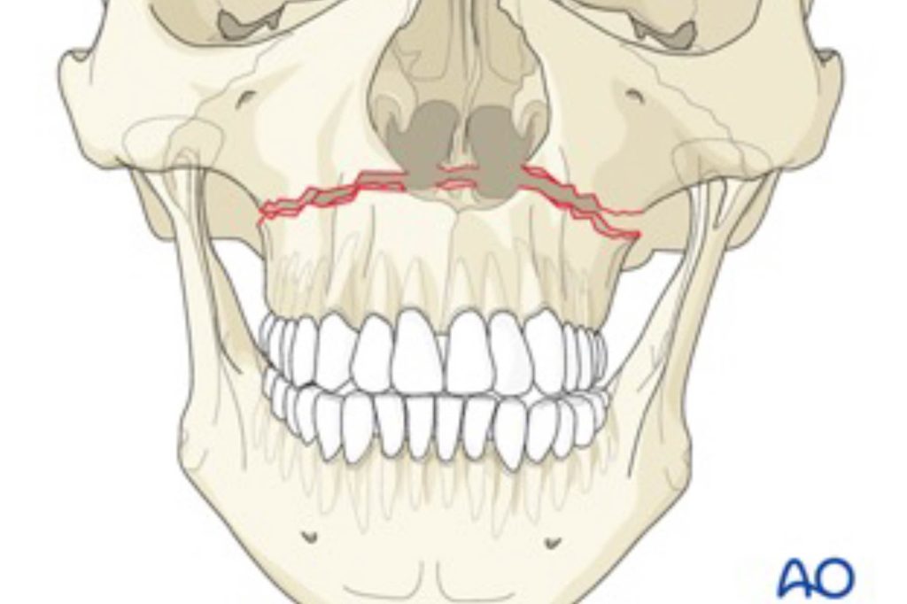A Dental Student's Guide to...Le Fort fractures - Dentistry