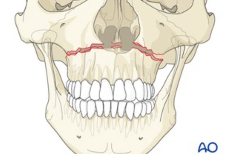 A Dental Student's Guide to...Le Fort fractures - Dentistry