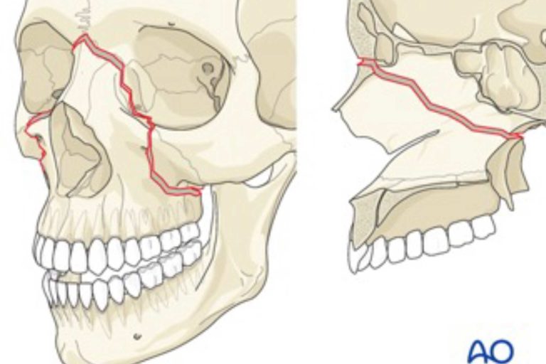 A Dental Student's Guide to...Le Fort fractures - Dentistry