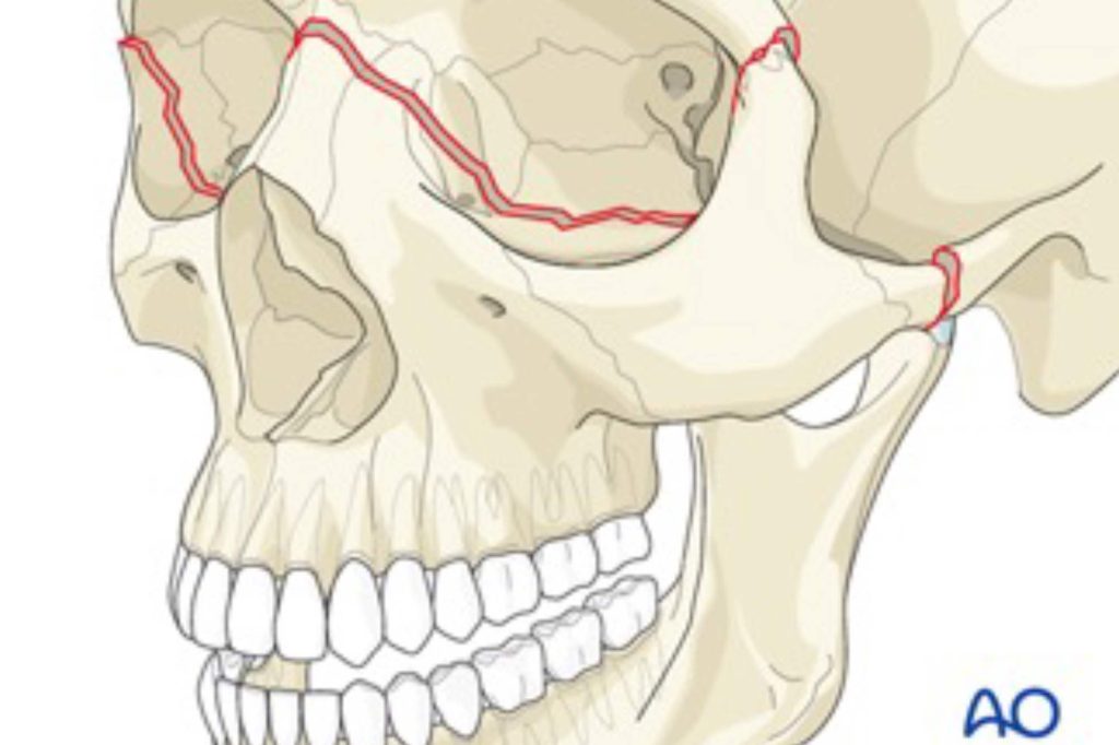 A Dental Student's Guide to...Le Fort fractures - Dentistry