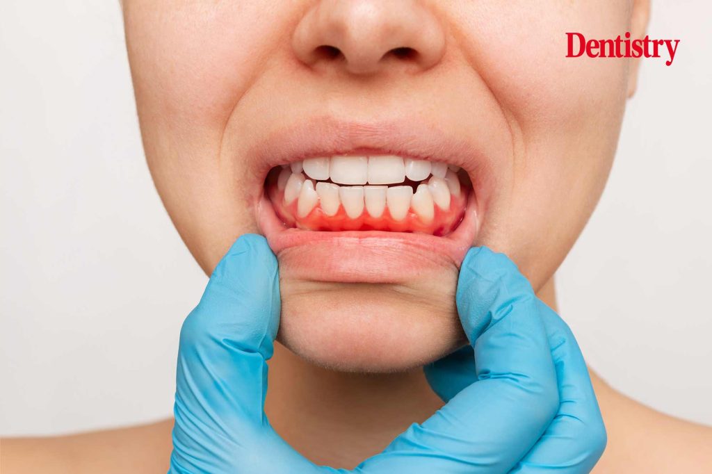 SDCEP to publish research into prevention of periodontitis - Dentistry