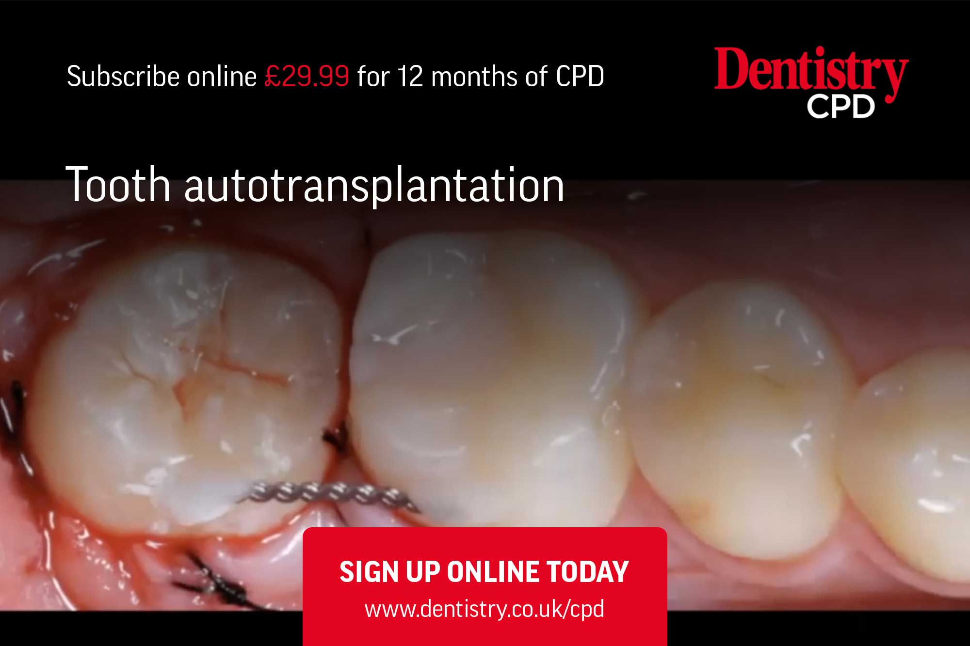 Watch tooth autotransplantation - Dentistry