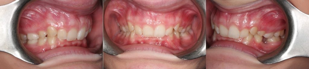 What are fixed functional appliances? - Dentistry