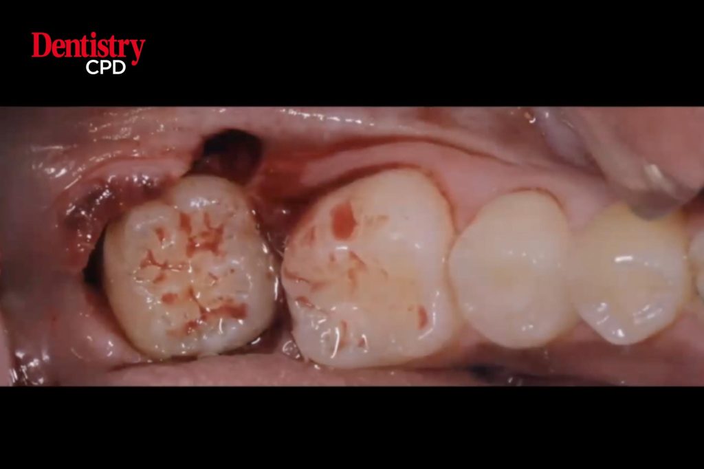 WATCH: tooth autotransplantation - Dentistry