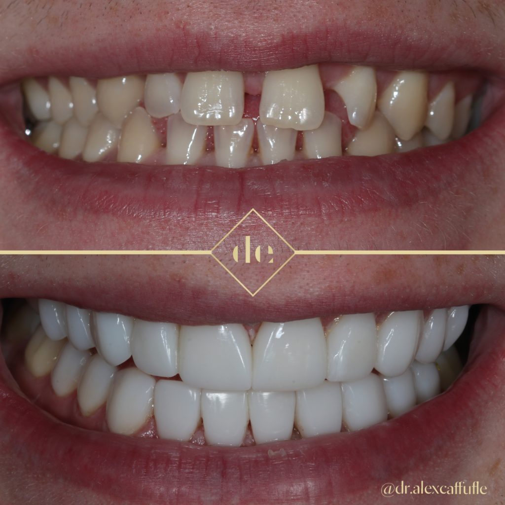 The injection-mould technique for composite veneers – Dentistry
