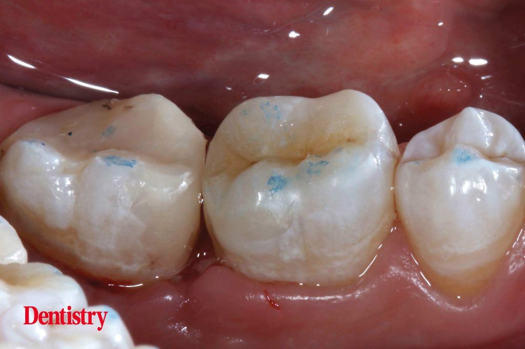 A CAD/CAM fabricated aesthetic onlay case - Dentistry