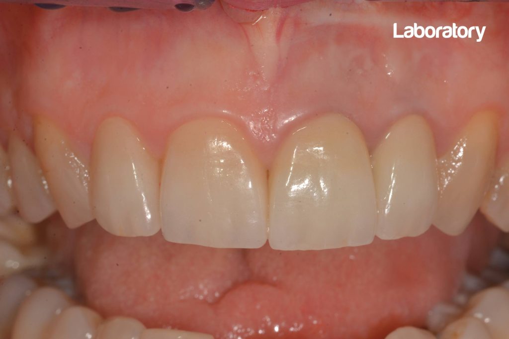 Incisal edge design on lithium disilicate crowns - Dentistry