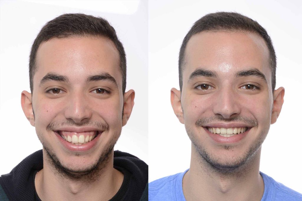How to treat gummy smiles using non-surgical methods - Dentistry