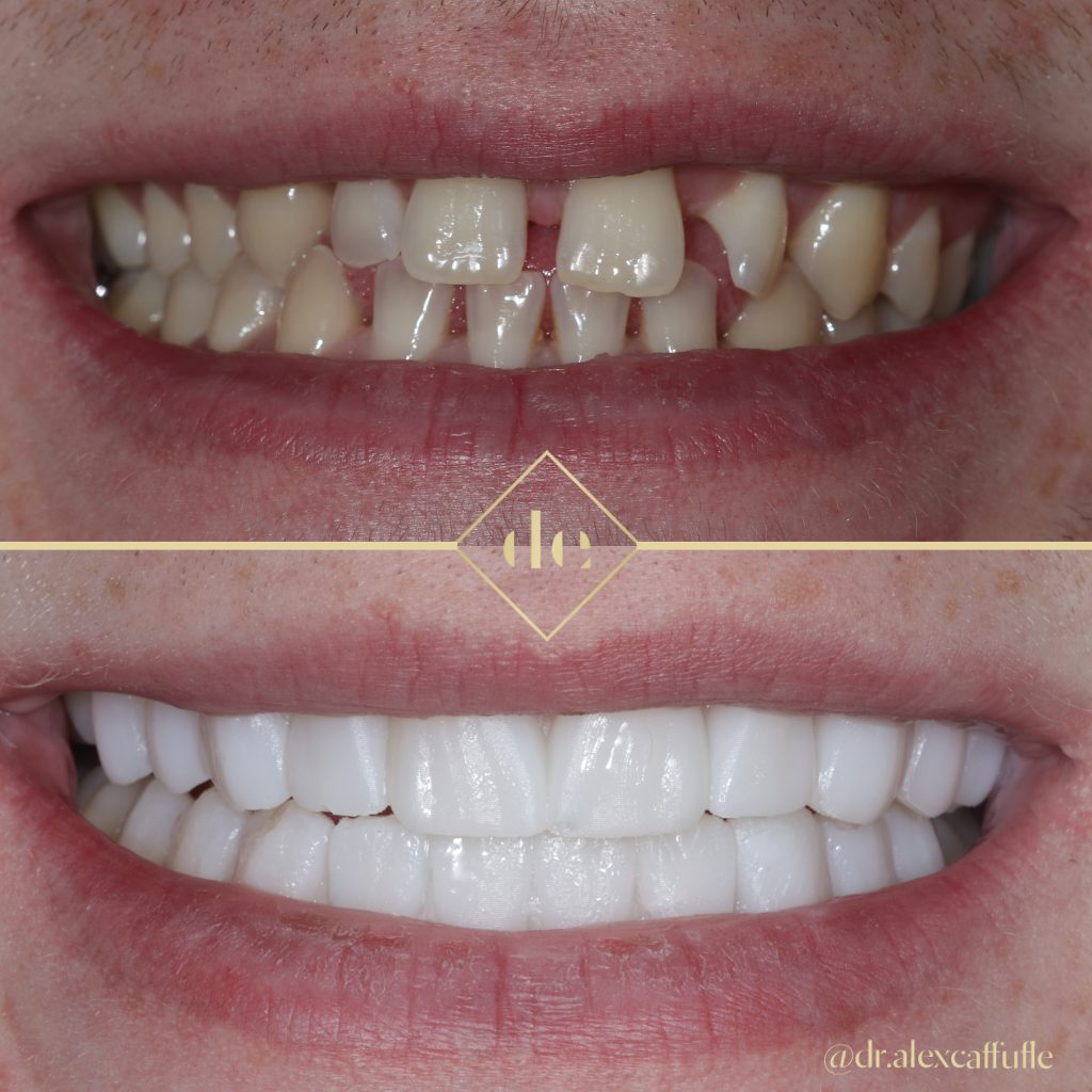The injection-mould technique for composite veneers – Dentistry