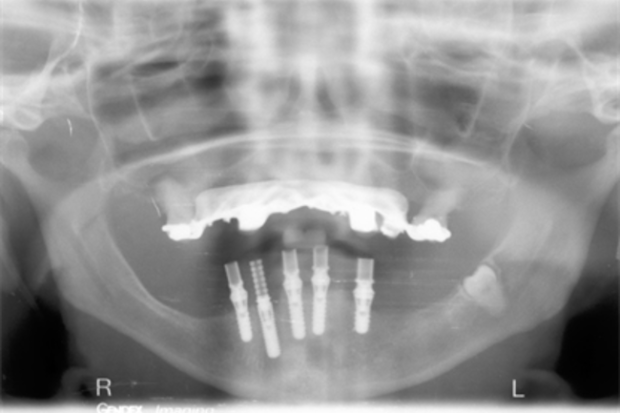 post op OPG - Dentistry.co.uk