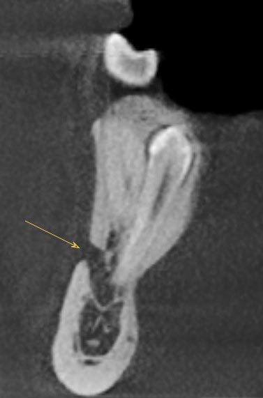 Case of the Week – unerupted supernumerary tooth - Dentistry
