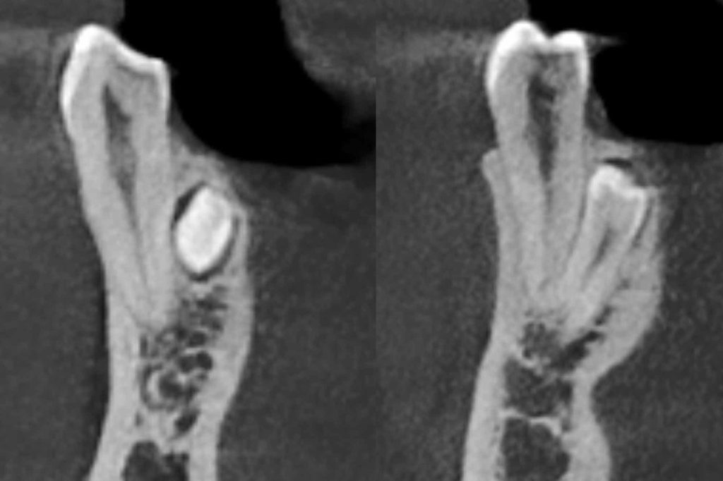 Case of the Week – unerupted supernumerary tooth - Dentistry