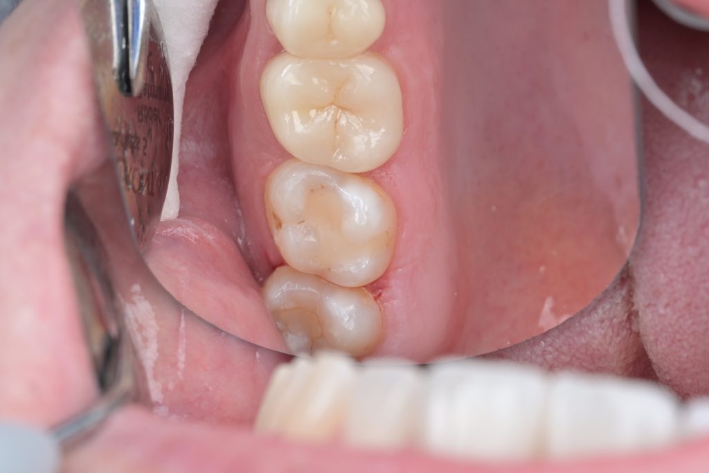 A cuspby-cusp additive technique with composite - Dentistry
