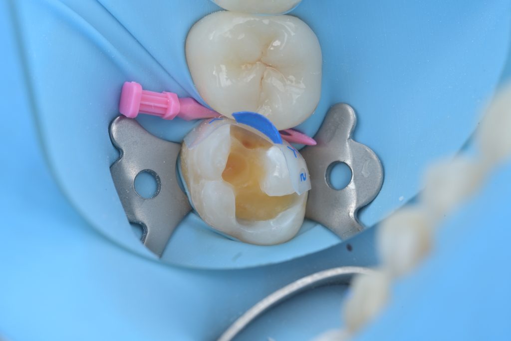 A cuspby-cusp additive technique with composite - Dentistry