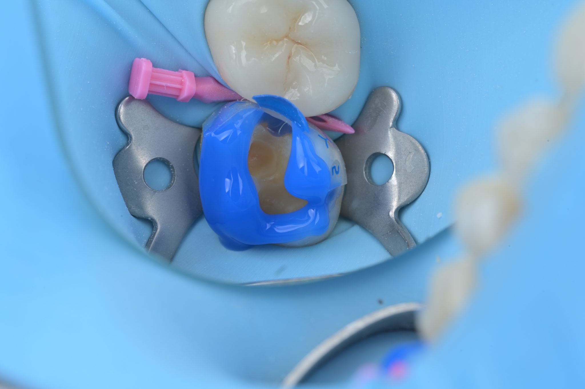 A cuspby-cusp additive technique with composite - Dentistry