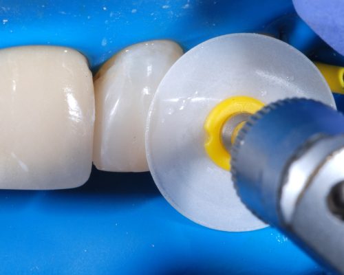 Optidisc – the polishing and contouring disc - Dentistry