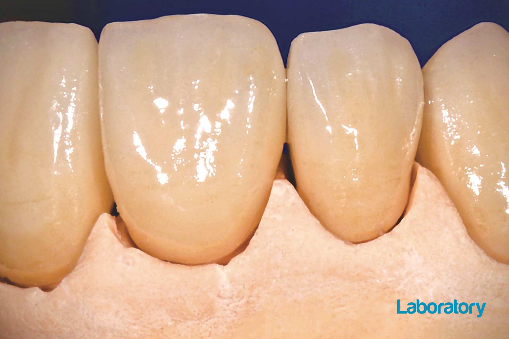 Digital press design crown case - Dentistry