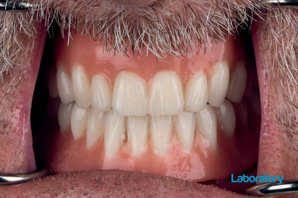Edentulous patient case with better precision - Dentistry