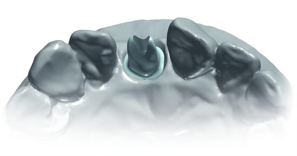 Creating a natural-looking crown - Dentistry