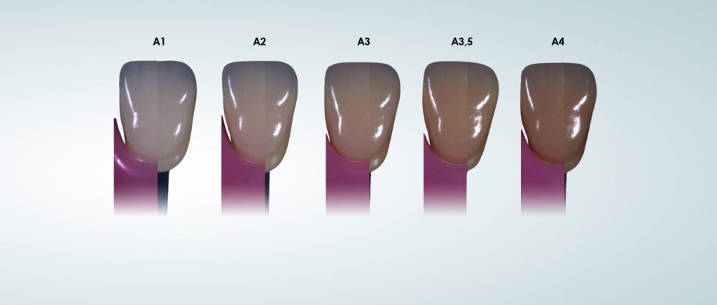 Creating a natural-looking crown - Dentistry