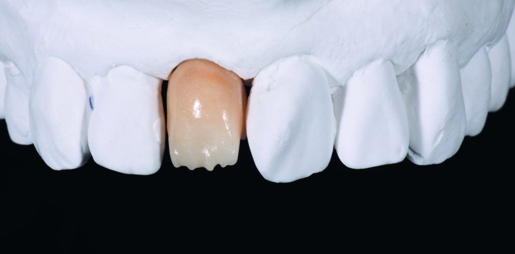 Creating a natural-looking crown - Dentistry