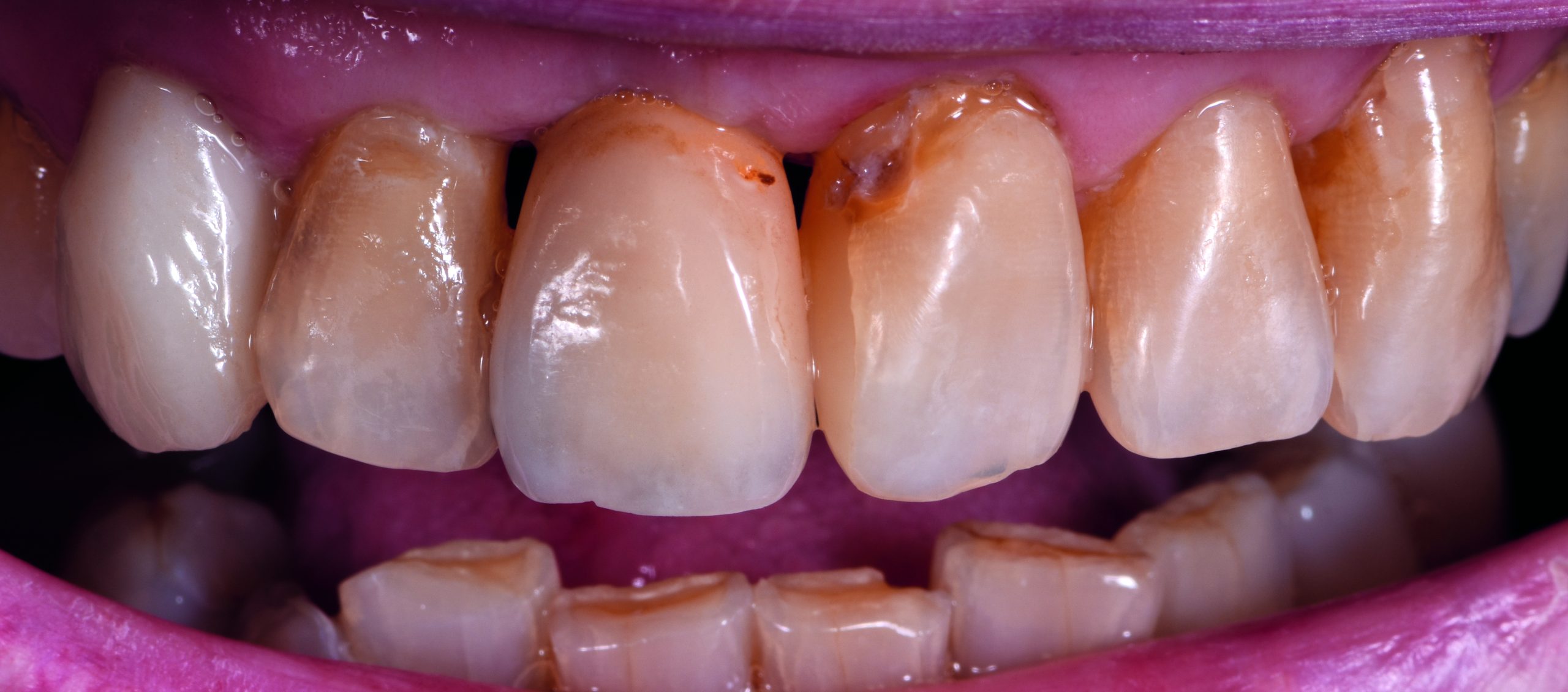 Creating a natural-looking crown - Dentistry