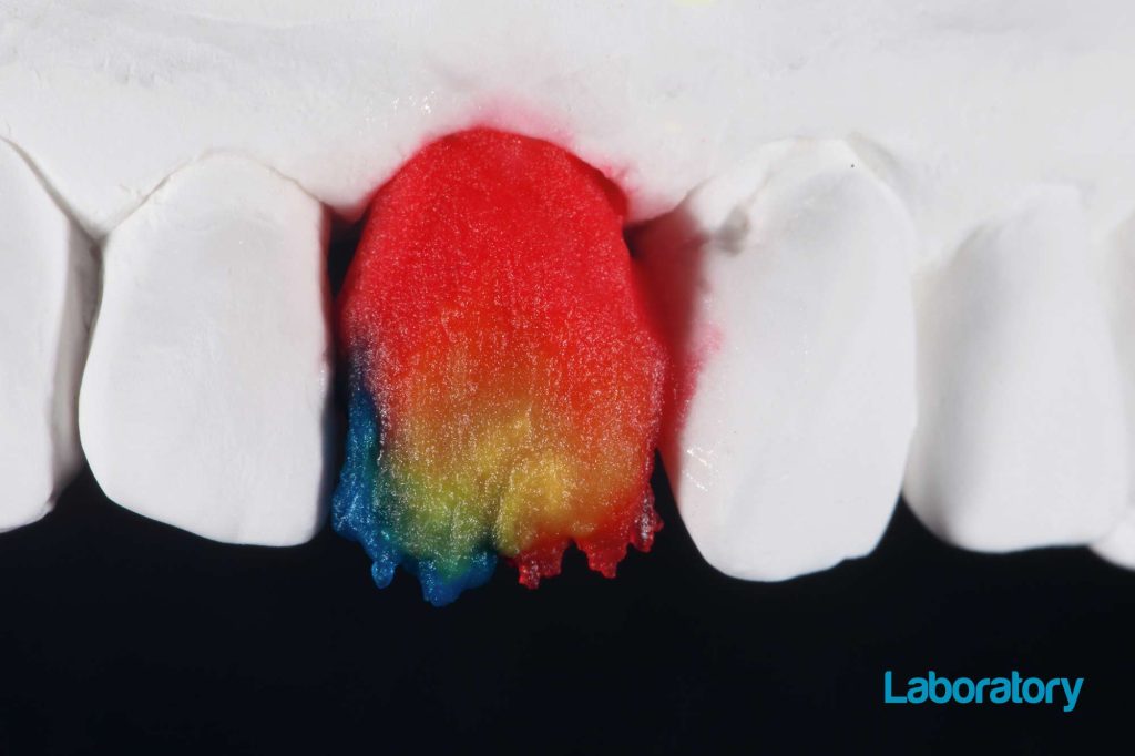 Creating a natural-looking crown - Dentistry