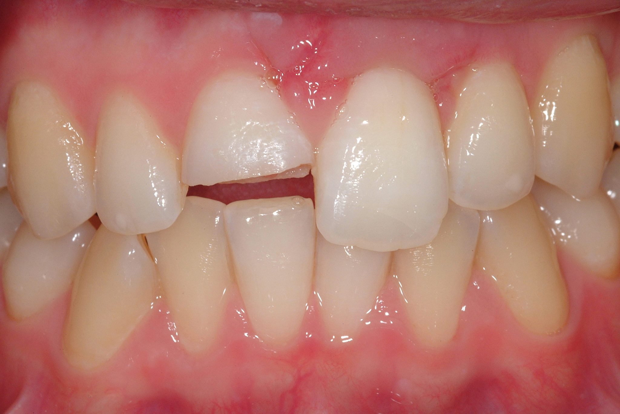 Ceramic crown for a complicated tooth fracture - Dentistry